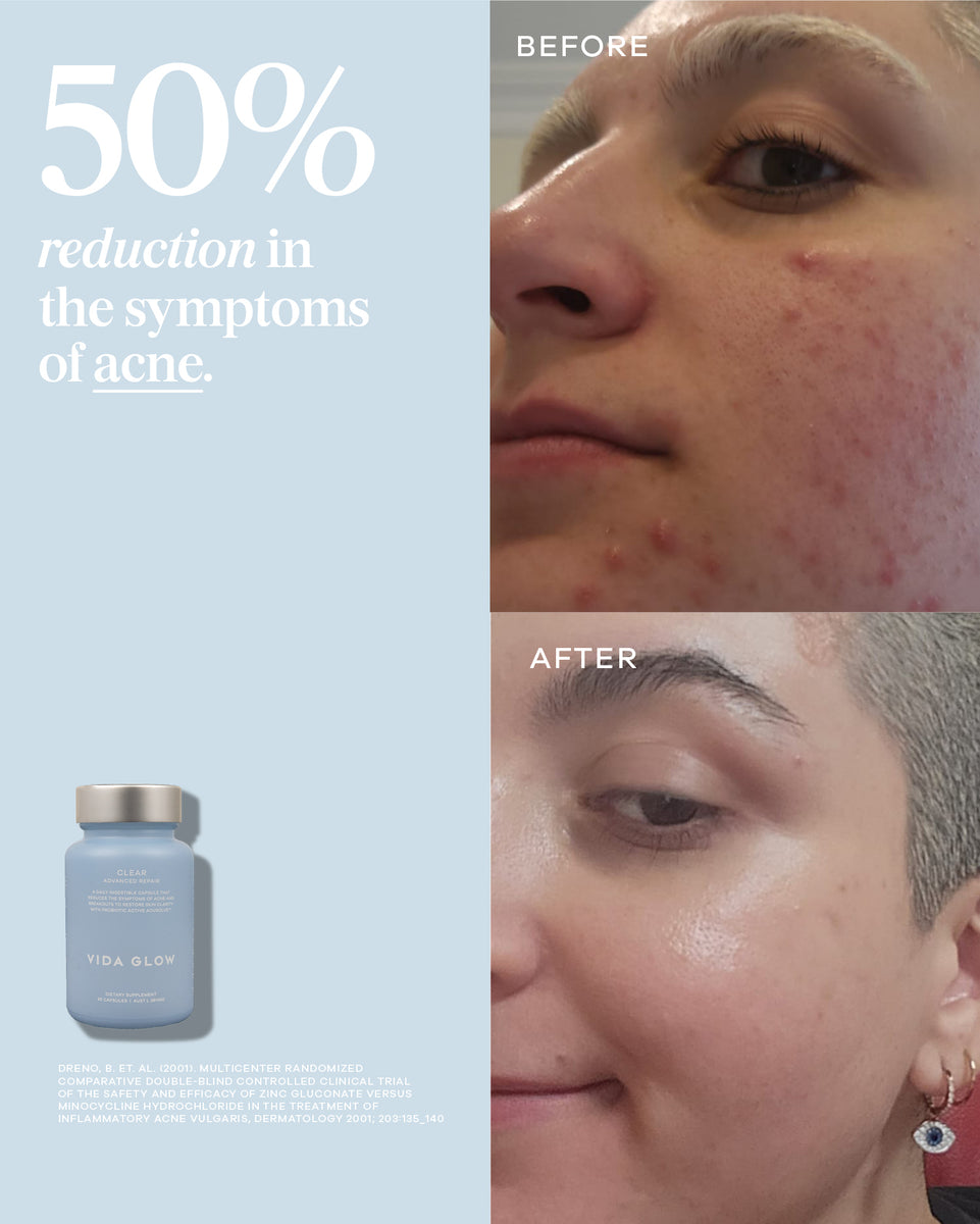 Clear Capsules - Acne Supplement | Vida Glow AU & NZ