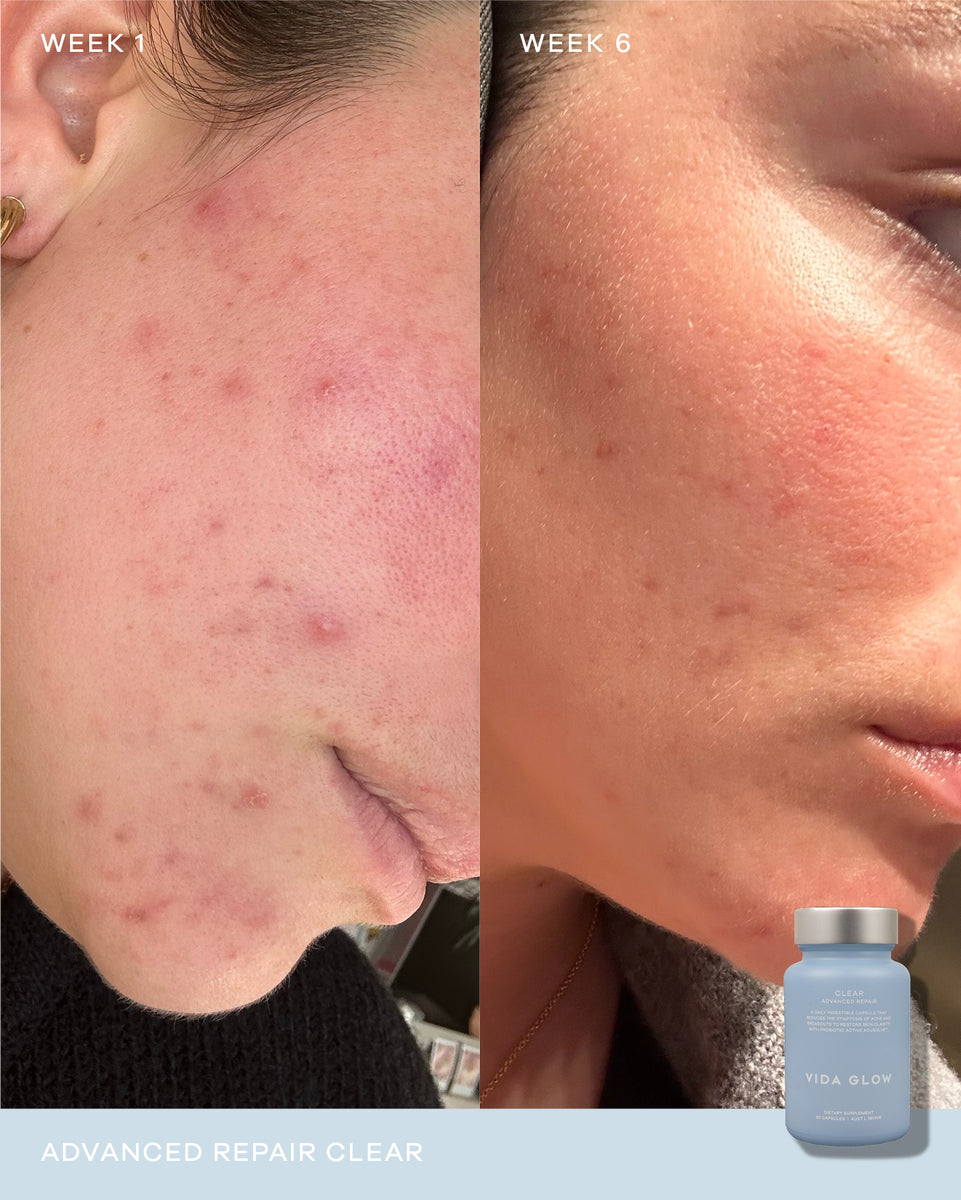Clear Capsules - Acne Supplement | Vida Glow AU & NZ